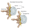 Treatments for Cervical Radiculopathy: The Ultimate Guide